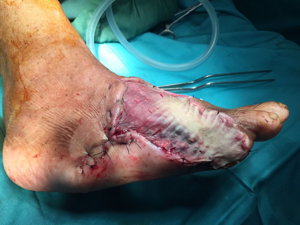 Salvataje de Pie Diabético Infectado - Dr. Cristian Añez Martínez